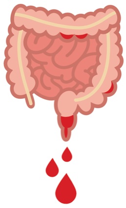 A Role for First-Line Surgical Treatment Of Lower GI Bleeding