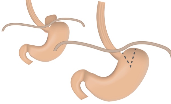 Collis Gastroplasty
