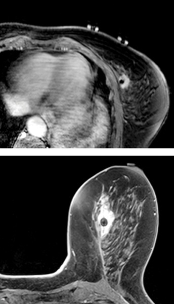 Supine MRI May Significantly Decrease Positive Margin Rates, Improve ...