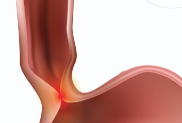 Laparoscopic Heller-Dor Cures Most Cases of Achalasia