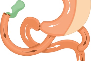 Study Compares Roux Duodenal Switch With SADI-S