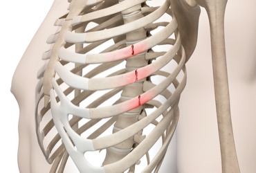 Rib Fractures