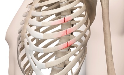 Metal Plates Outperform Resorbable Plates in Study of Rib Fractures