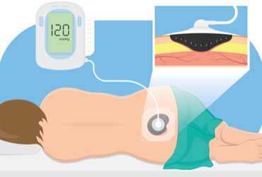 Data Grow for Negative Pressure Wound Therapy With Instillation, Dwell Time