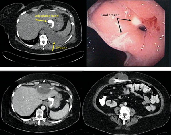 The Surgeons’ Lounge: Partial Gastric Band Erosion