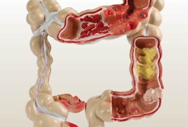 Appendicitis and Diverticulitis: Blending Clinical Evidence and Shared ...