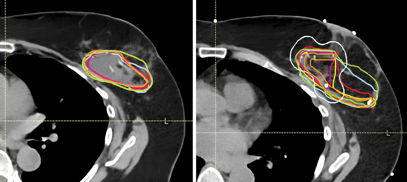Study Indicates Superiority of VeraForm ® Marker Over Clips During ...