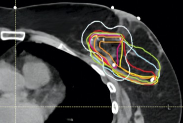 Study Indicates Superiority of VeraForm® Marker Over Clips During ...