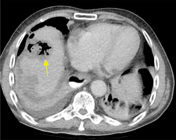 Pyogenic Liver Abscess Colorectal Cancer Association