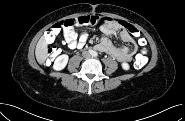 The Surgeons’ Lounge: Management of Intussusception