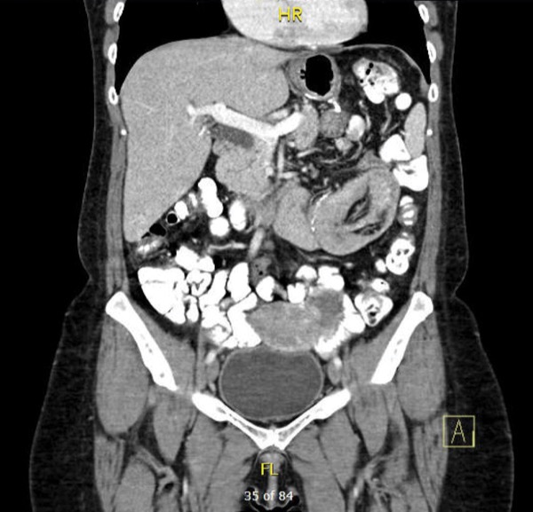Gastric Bypass Intussusception Management