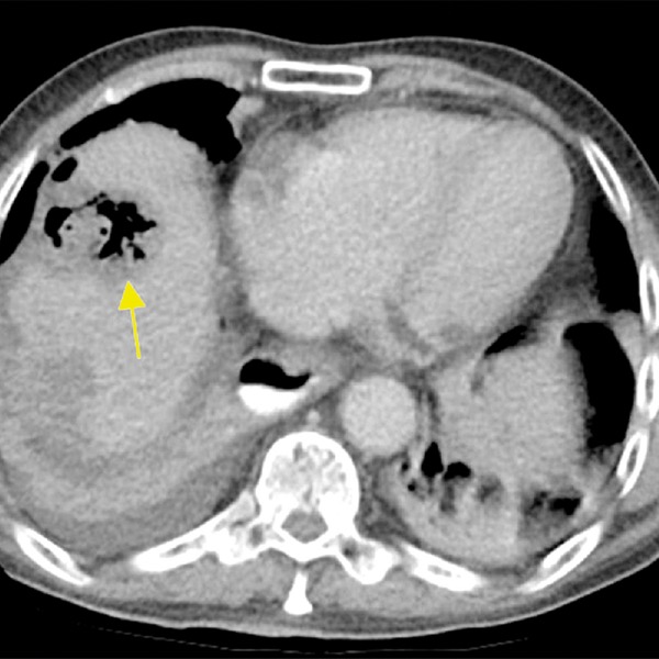 Pyogenic Liver Abscess Colorectal Cancer Association