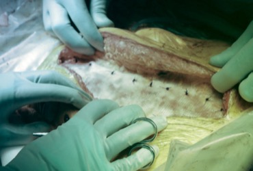 Mesh Incisional Hernia Prevention Factors