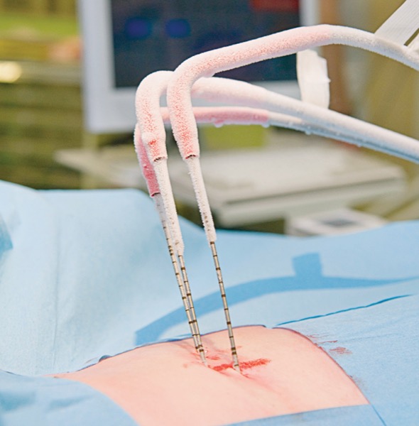 Cryoablation Abdominal Surgery Pain Relief