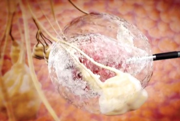 Cryoablation On Par With Excision for Early-Stage Breast Cancer Recurrence