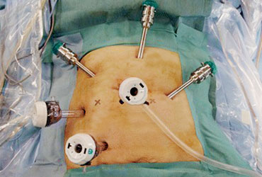 Robotic Surgery Benefits Rectal Cancer